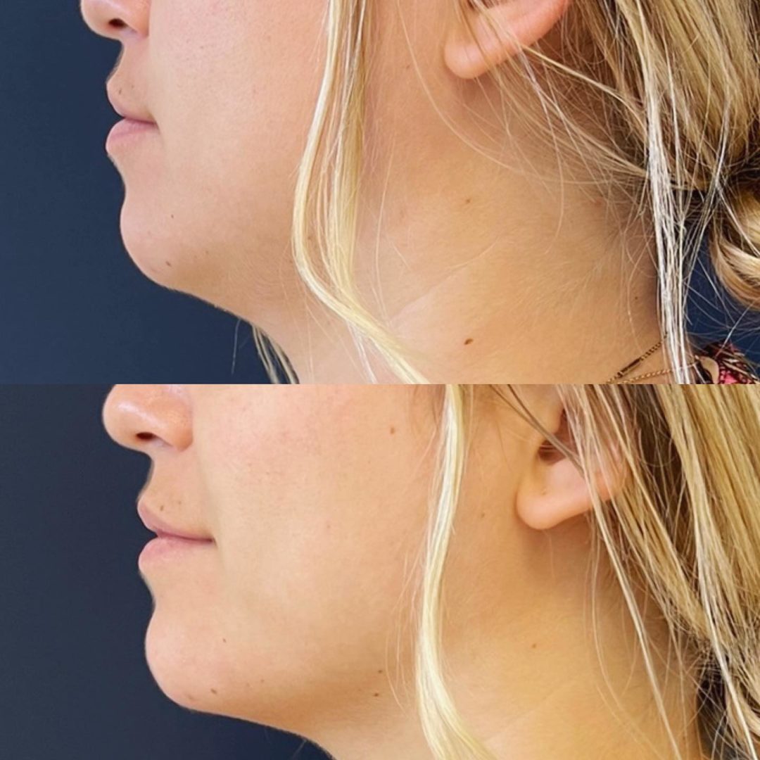 Traitement du menton par l'acide hyaluronique - CMEGE Genève